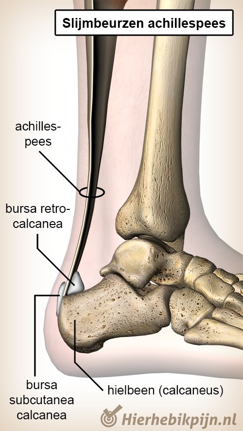 Slijmbeursontsteking hiel | Slijmbeursontsteking - Physiocheck.co.uk