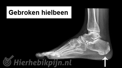 Gebroken hielbeen | Botbreuk - Physiocheck.co.uk